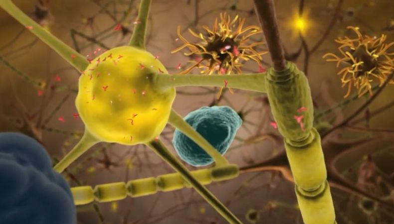 ¿Conoce qué es la esclerosis múltiple?