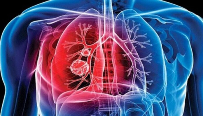 ¿Cómo prevenir la tuberculosis?