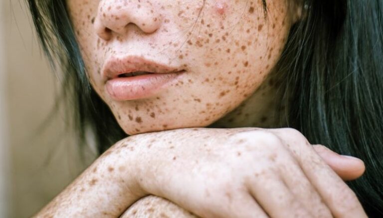 ¿Conoce las manchas cutáneas en la piel?